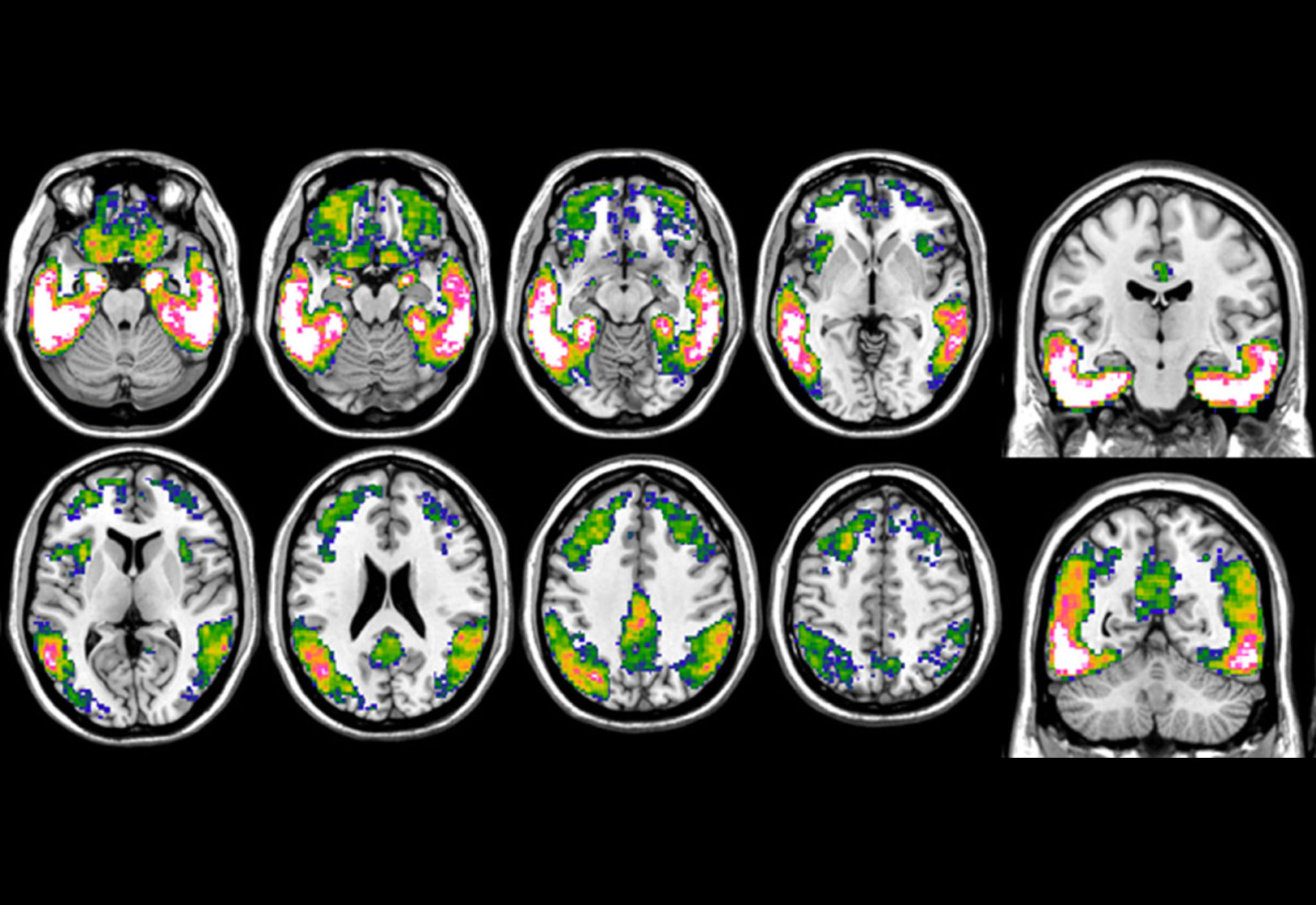 HUG And UNIGE Unveil The Next Frontier In Alzheimer s Diagnosis hug-and-unige-unveil-the-next-frontier-in-alzheimer-s-diagnosis